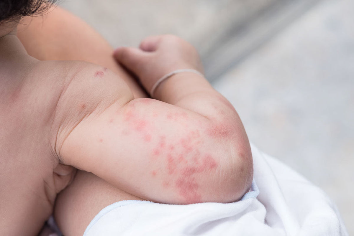 Dermatite atopica nei neonati: cause, sintomi e rimedi – Byoama